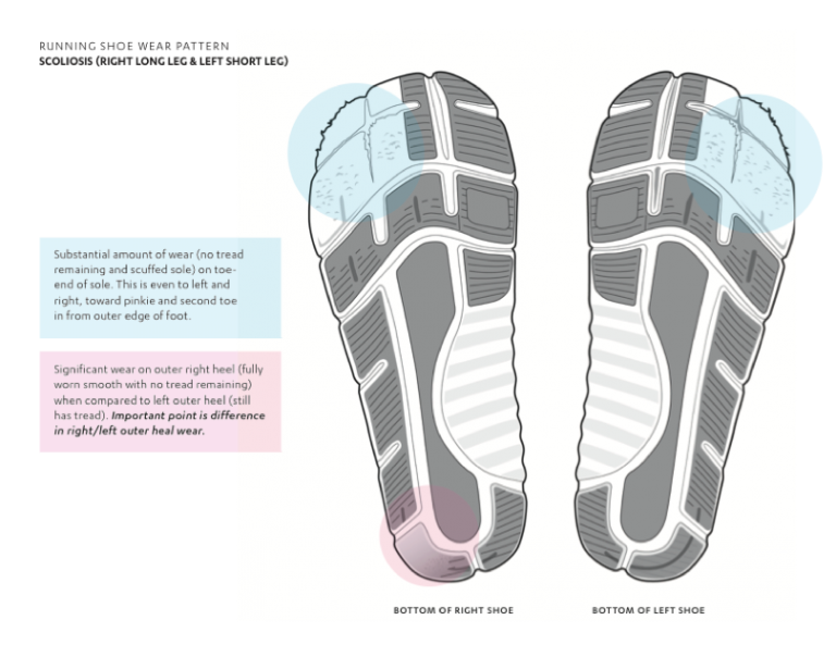 Running Injuries: A Problem of the Sole – Pasadena Pacers